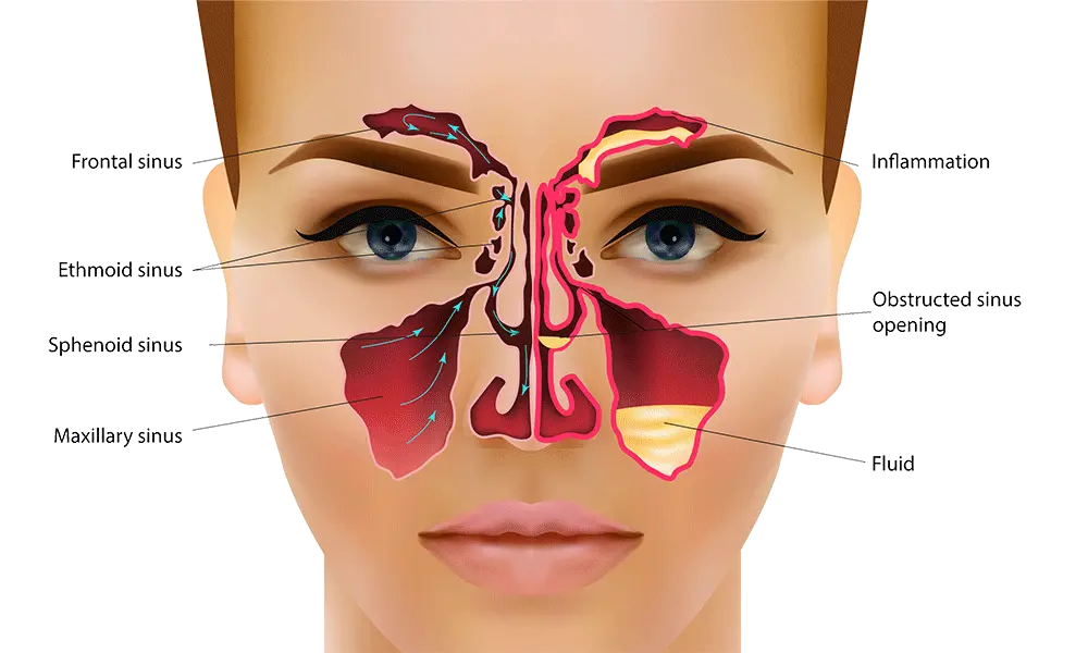 Sinusitis: Tips To Help You Manage It - Medical Channel Asia