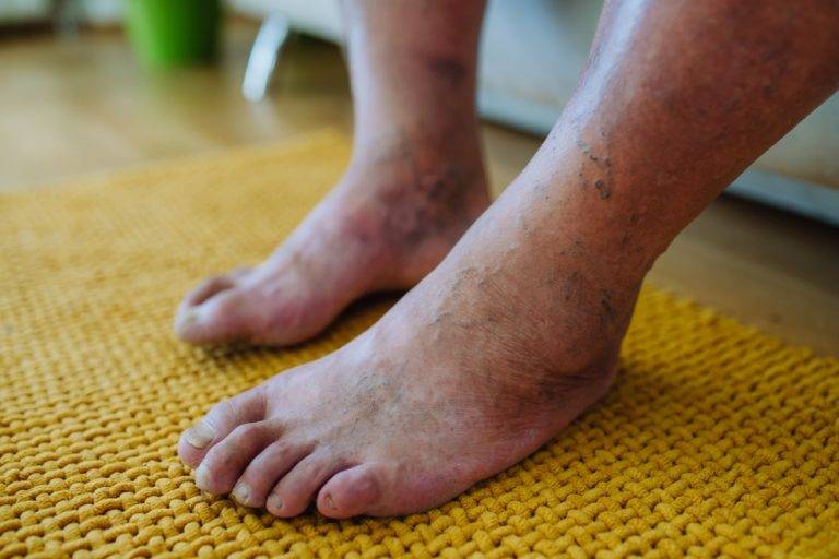 Diabetes & Foot Health: How To Keep Your Feet Healthy
