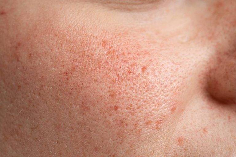 Understanding Asian Flush: Is Your Red Face Caused by Alcohol ...