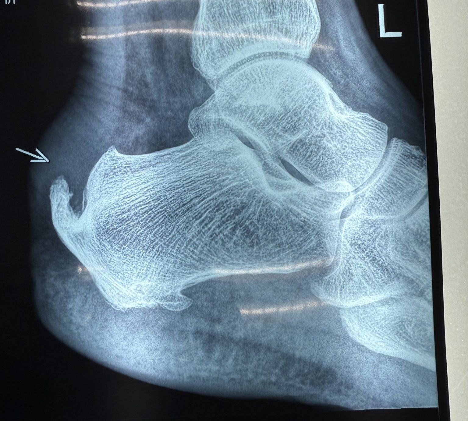 Could Bone Spurs Be the Cause of Your Swollen and Painful Feet ...