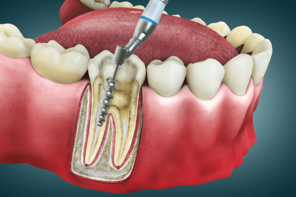 Aftercare Tips For A Successful Root Canal Recovery - Medical Channel Asia