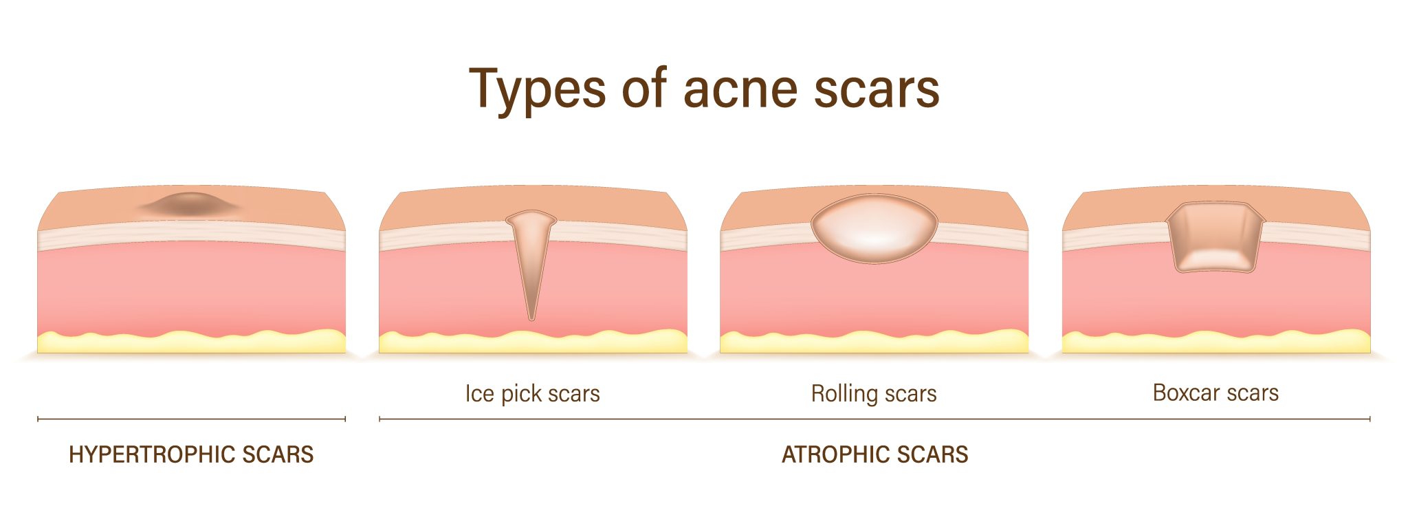 Tried Everything for Acne Scars? Fillers Might Help - Medical Channel Asia