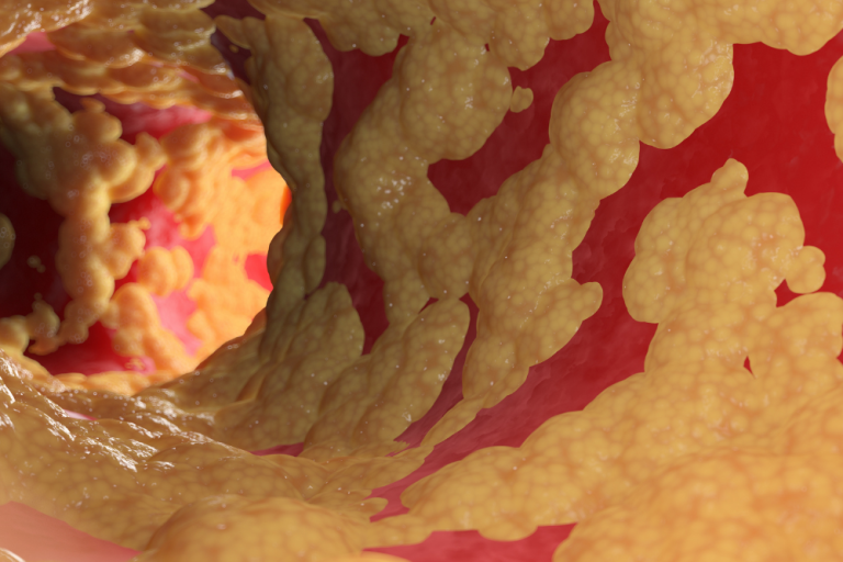 Hidden Belly Fat Could Be Raising Your Health Risks - Medical Channel Asia