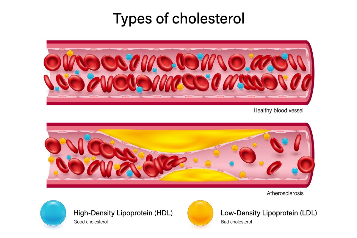 6 Natural Ways to Lower Your Cholesterol Without Using Drugs - Medical ...